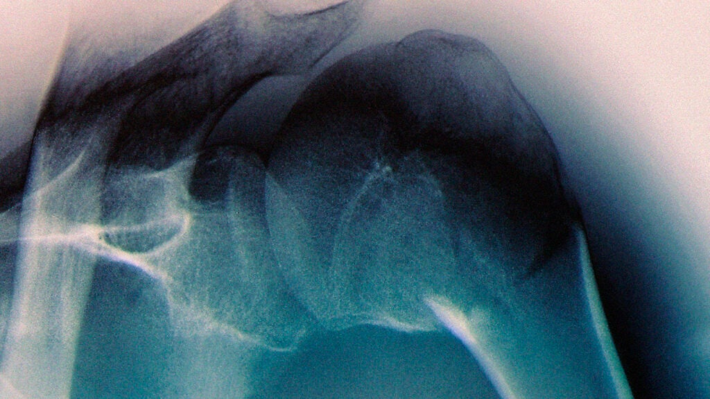 Shoulder bones: Anatomy and common problems