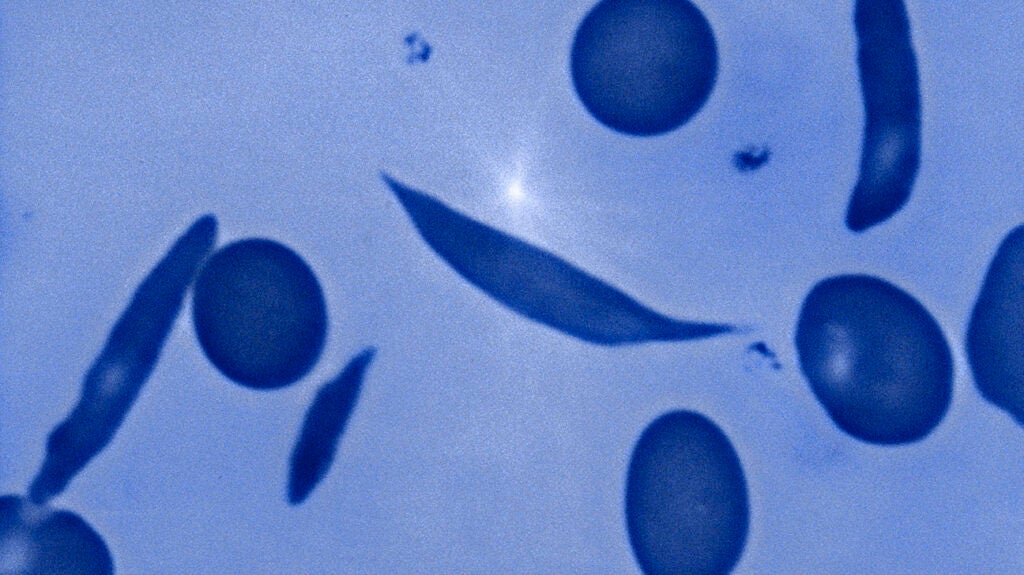 Sickle cell pain crisis: Triggers, treatment, and home remedies