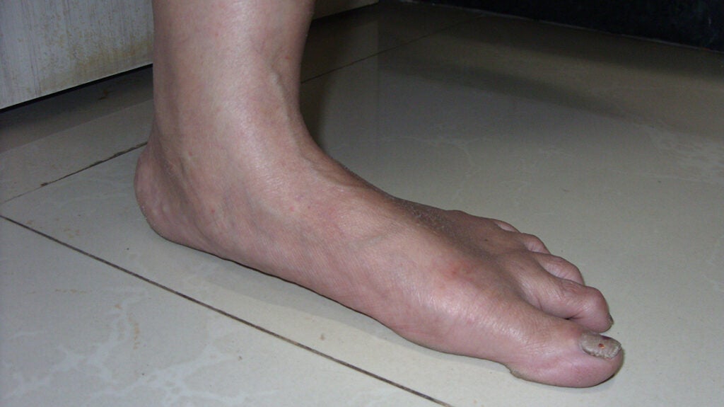 Flat feet: Symptoms, exercises, diagnosis, and treatment
