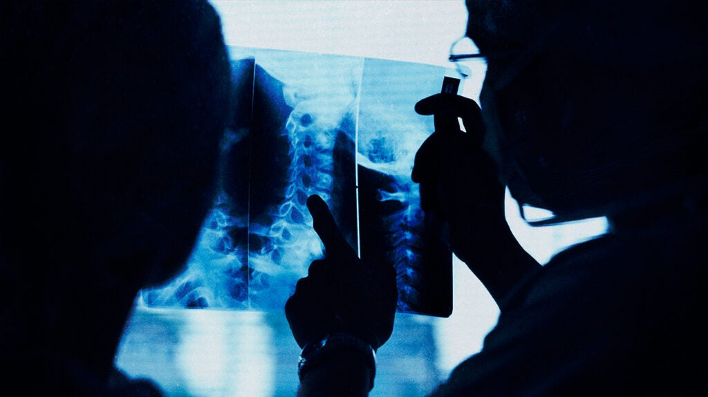 What are lytic lesions and how do they relate to multiple myeloma?