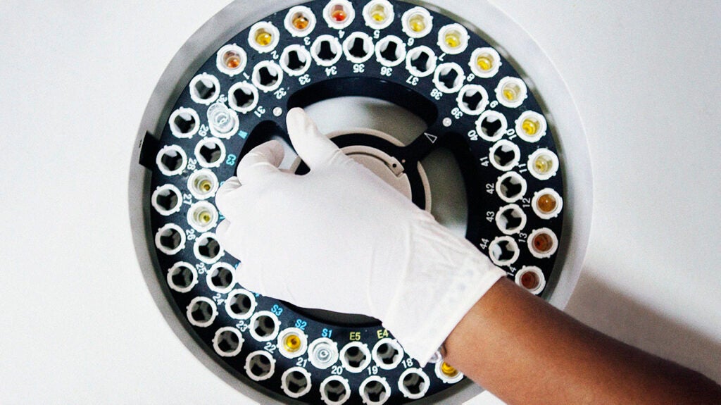 Homocysteine levels: What it means, symptoms, treatment