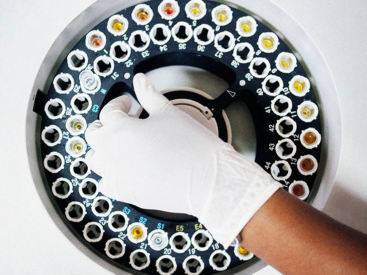 Homocysteine levels: Symptoms, complications, and treatment