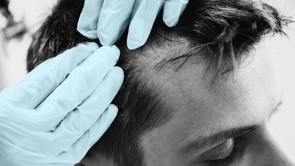 Auspitz sign in psoriasis: Symptoms, causes, treatment & more