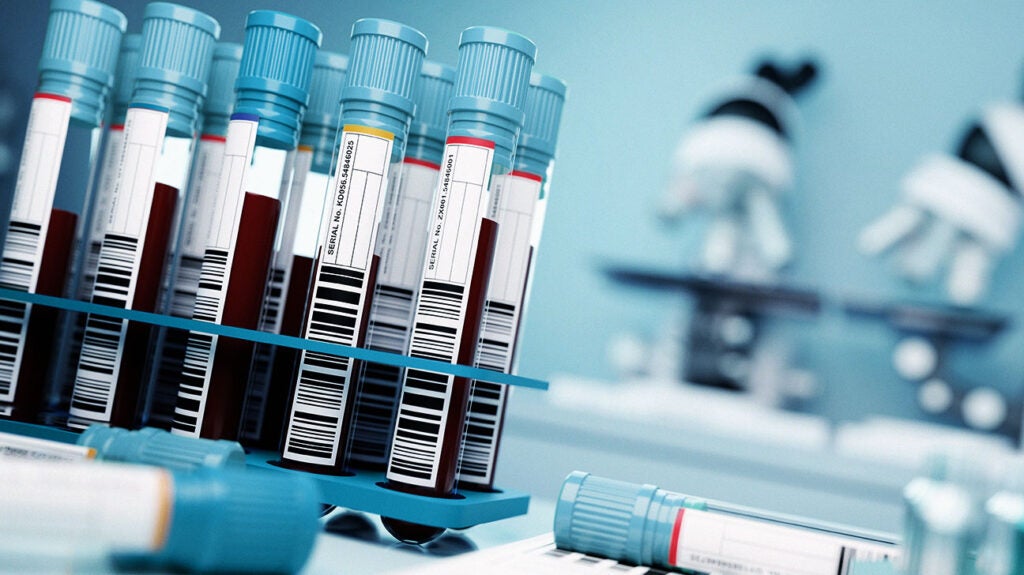 How is multiple sclerosis tested and di