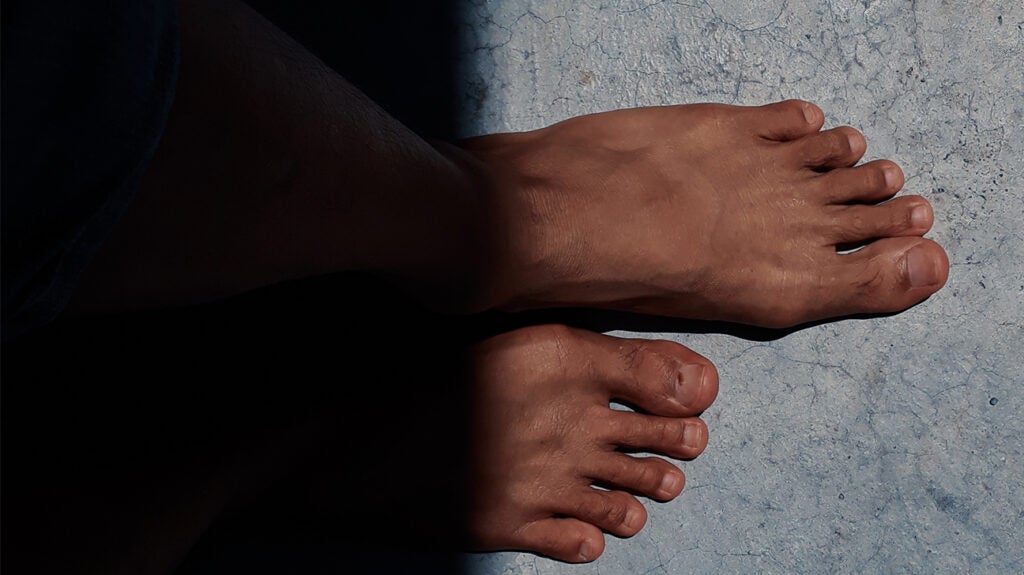 Palmoplantar Psoriasis: Causes, Symptoms, Risks, Treatment