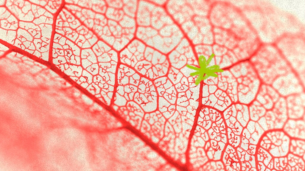 Anomalous coronary artery: Causes, symptoms, diagnosis, and more