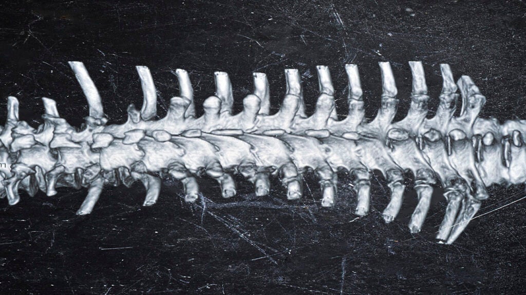 Transverse myelitis: Symptoms, treatment, causes, and more