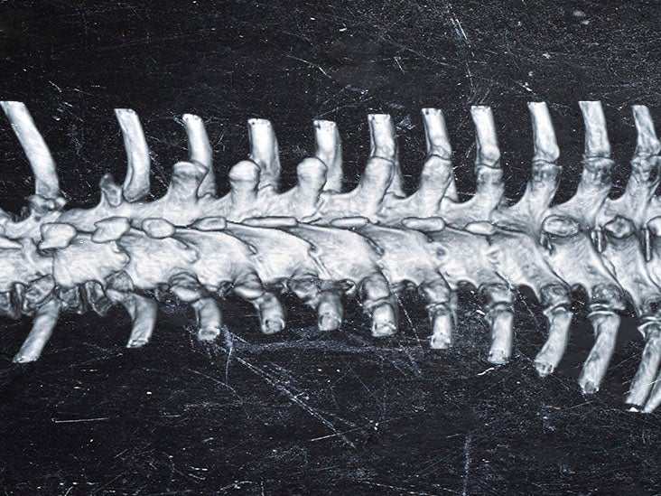 Transverse myelitis: Symptoms, treatment, causes, and more