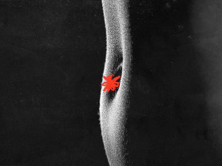 Psoriasis in the bellybutton: What to know, treatments, and more