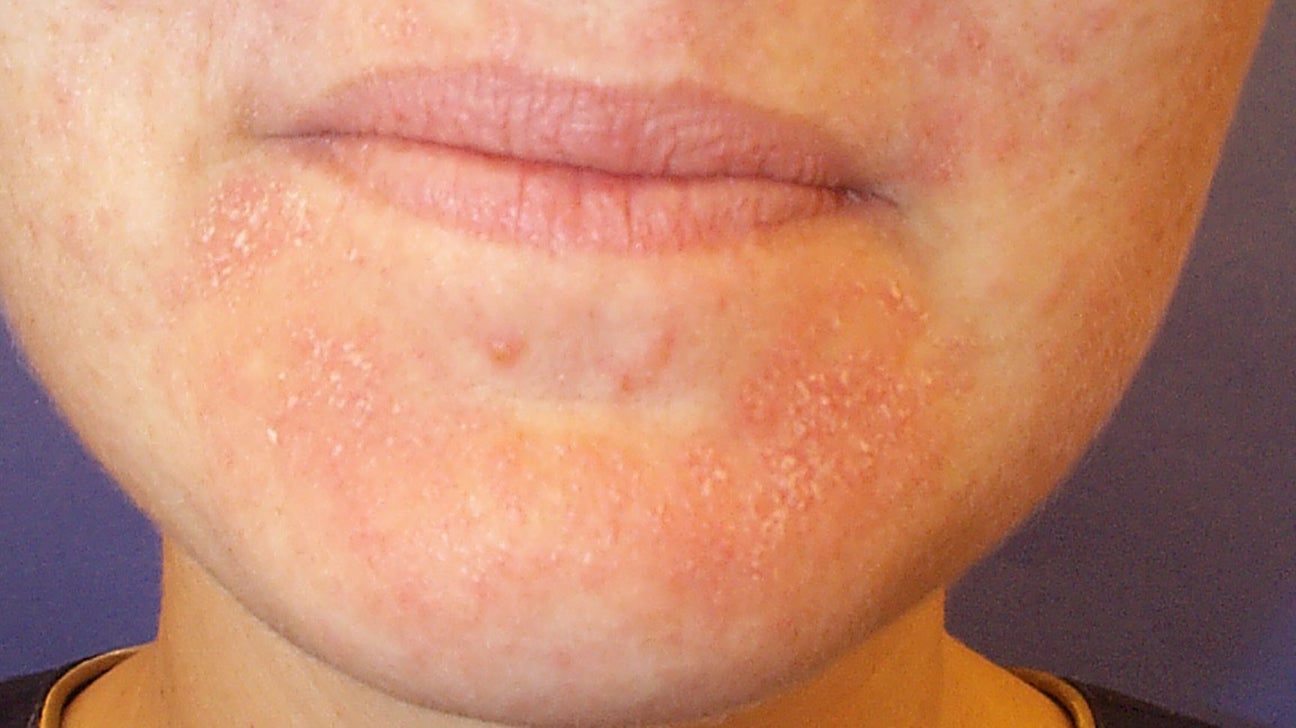 Skin Purging Breakout How To Tell The Difference 59 OFF Skin Purging Breakout How To Tell The Difference 59 OFF