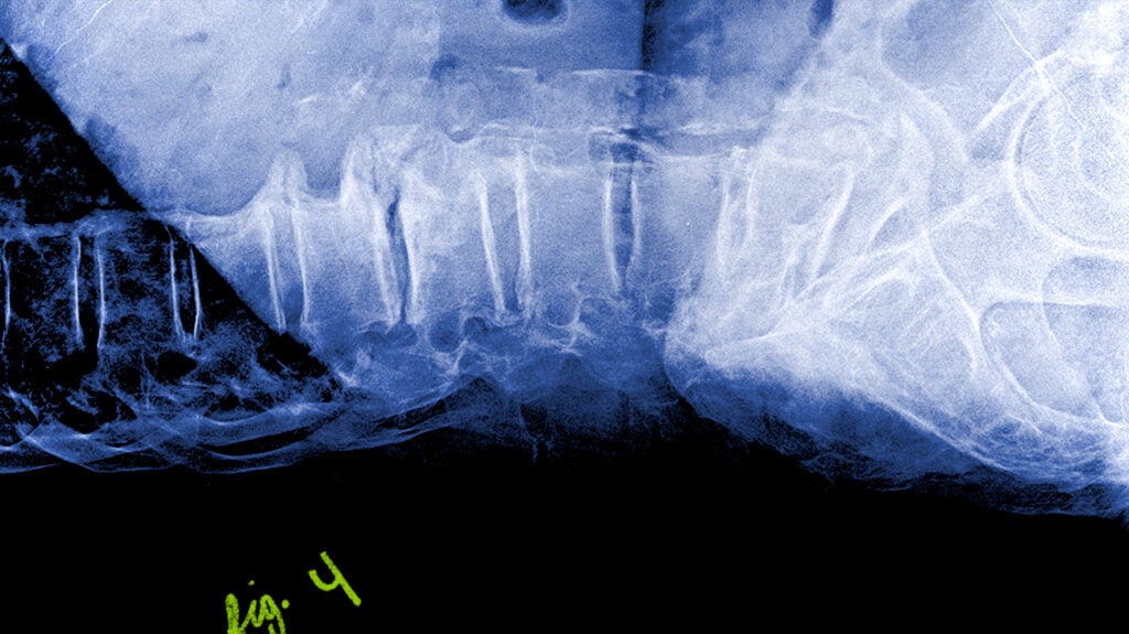 What are syndesmophytes, and what is their link with AS?