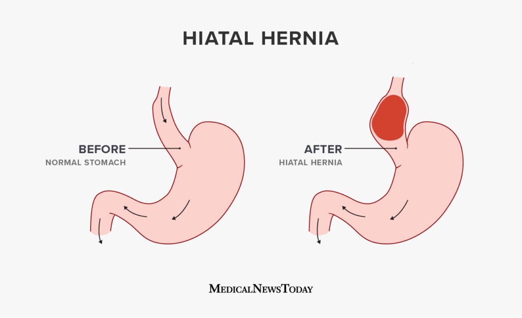 Hiatal Hernia Hiatal Hernia