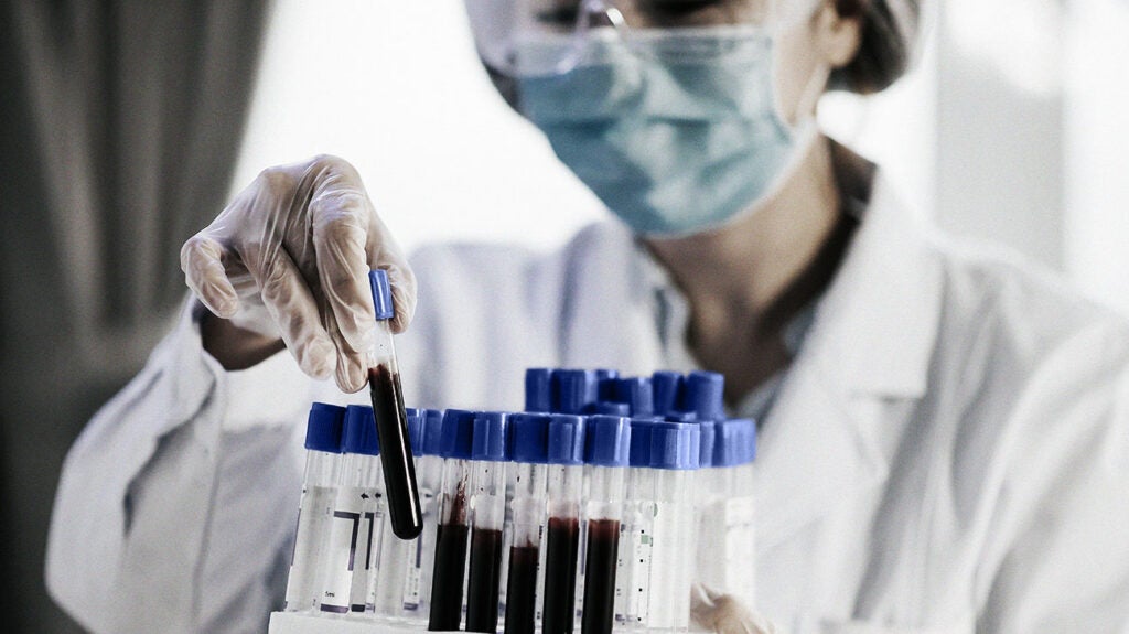 Rheumatoid arthritis and CRP levels: What is normal?