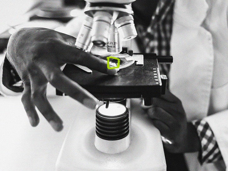 HRD testing ovarian cancer: What does a positive result mean?