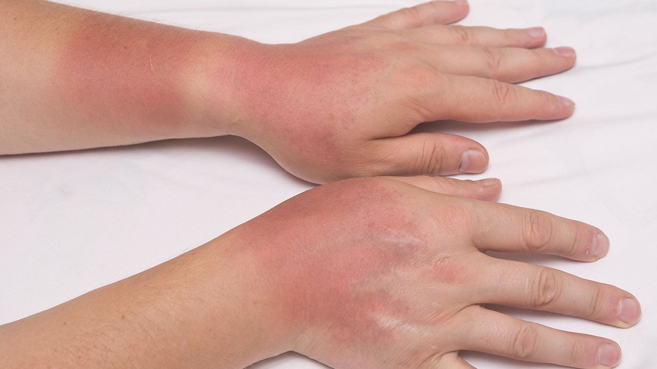 Allergy Tingling Eos Level Hand Ache Discount Varsana Allergy Tingling Eos Level Hand Ache Discount Varsana