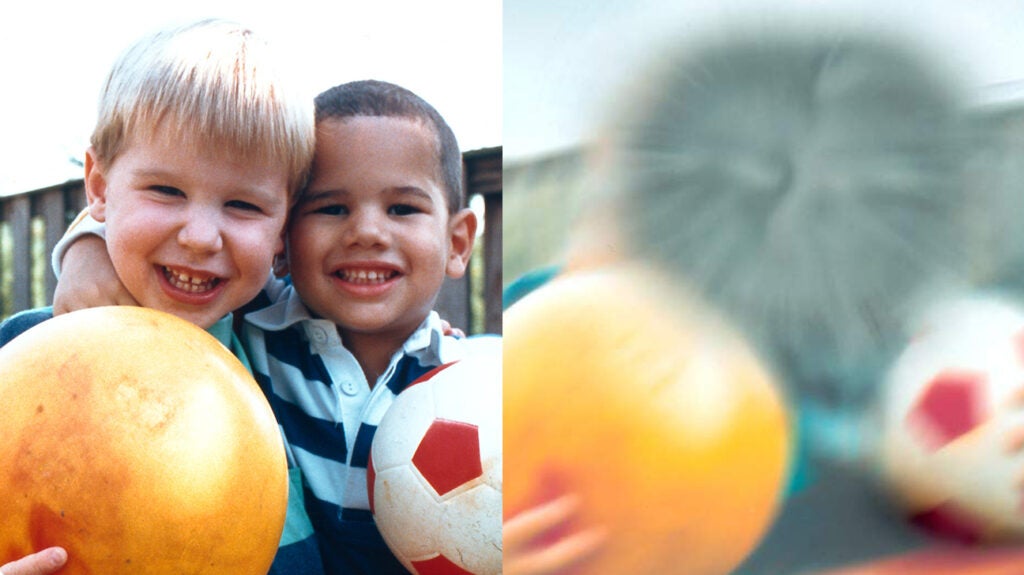 Age-related macular degeneration (AMD): Symptoms and treatment