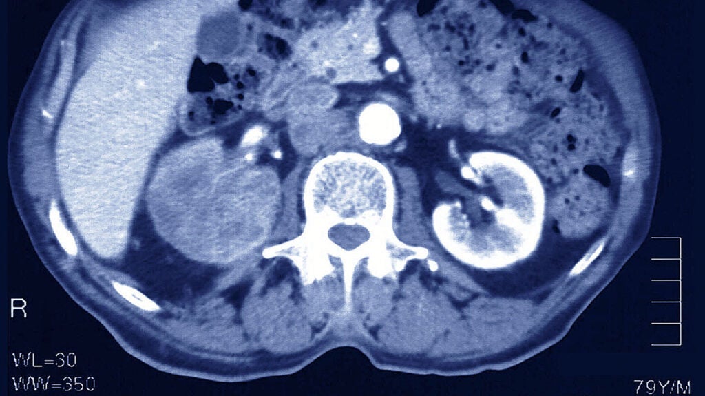 Chromophobe renal cell carcinoma: Signs, staging, and outlook