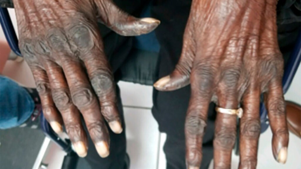 Hyperpigmentation: Types, treatment, and causes