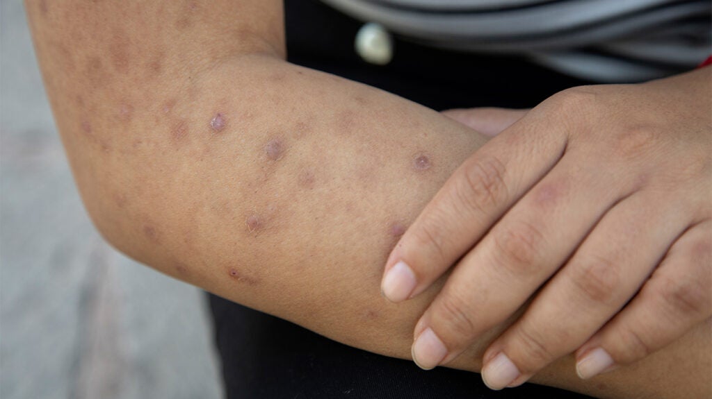 Hyperpigmentation: Types, treatment, and causes