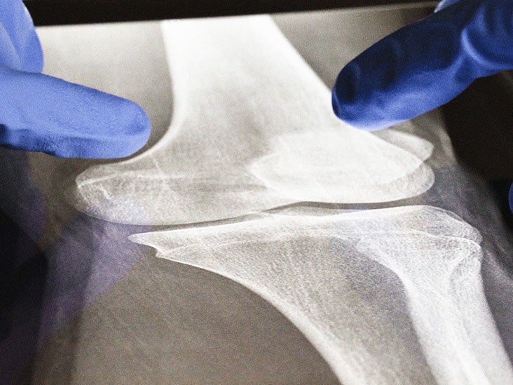 Osteosarcoma: Symptoms, causes, and treatment