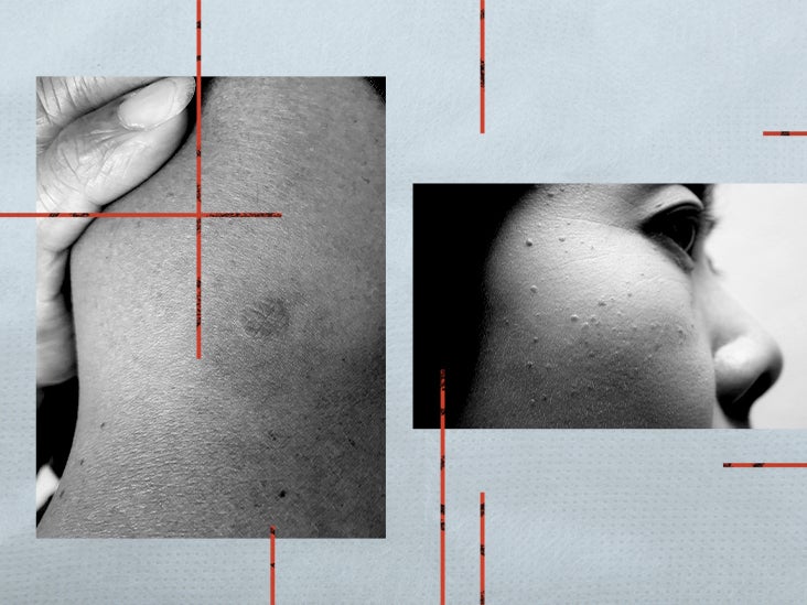 Seborrheic keratosis: Symptoms, treatment, and causes