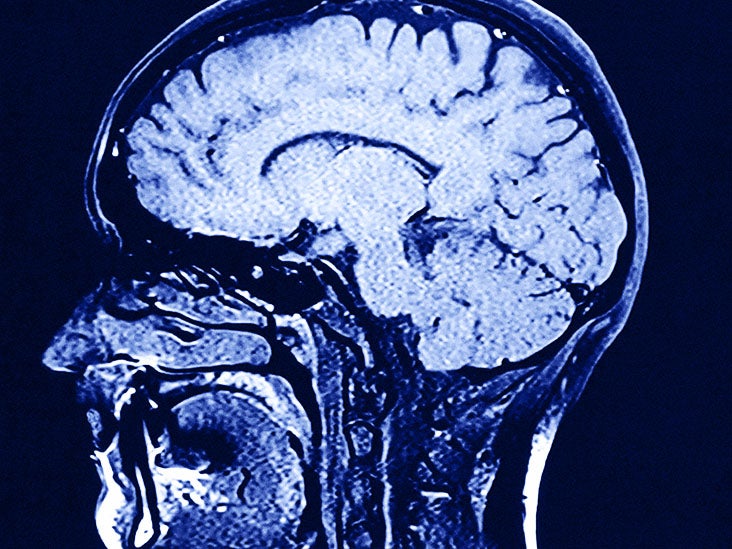 Lissencephaly (Smooth brain): Overview, symptoms, causes, and more
