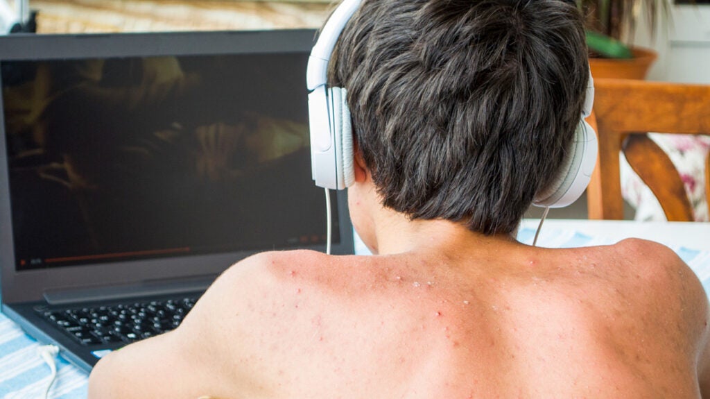 Shoulder acne: Types, causes, and how to get rid of it