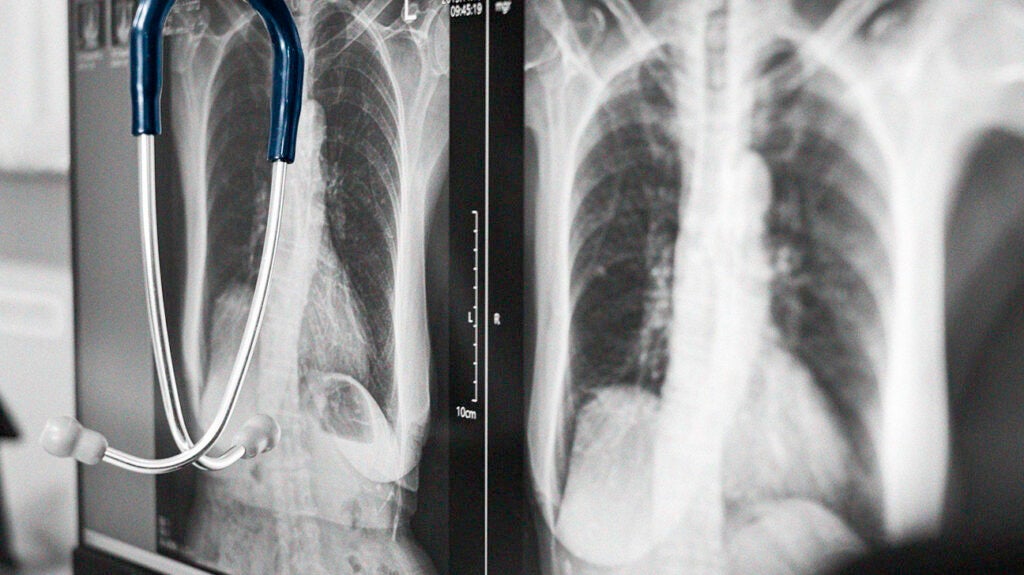Embolism Pulmonary Embolism Treatment In New Jersey Lung Vascular