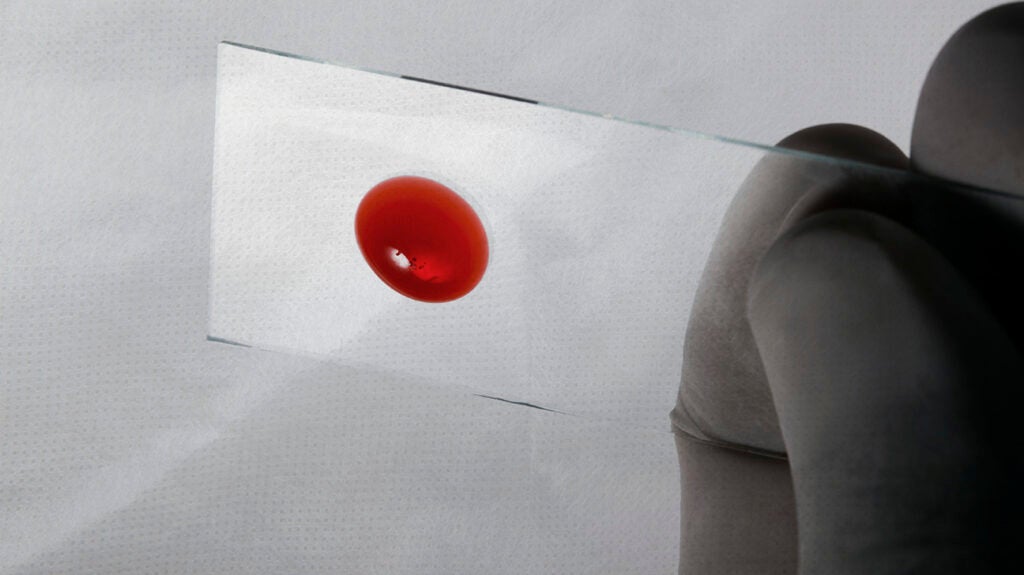 Shock liver: Symptoms, treatment, and outlook