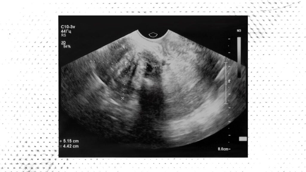 Uterine Artery Embolization Purpose And Procedure