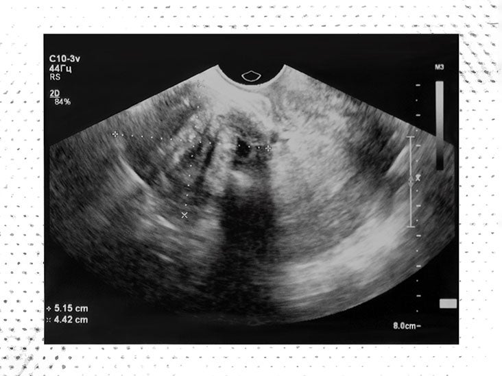 Uterine artery embolization: Purpose and procedure