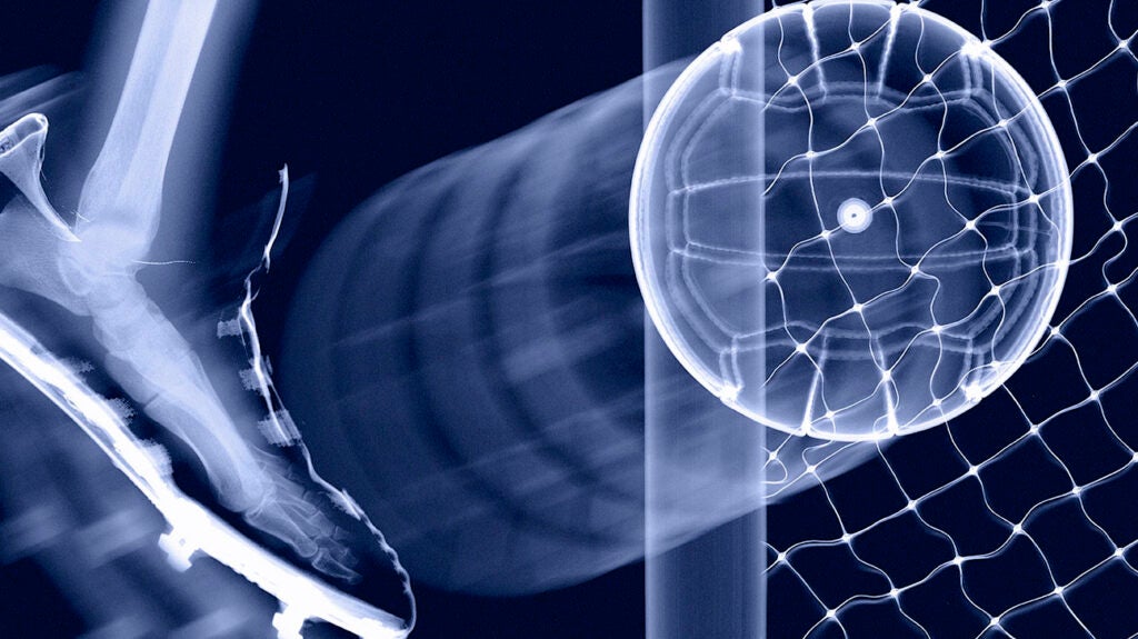 Jones fracture: Treatment, symptoms, pictures, and healing