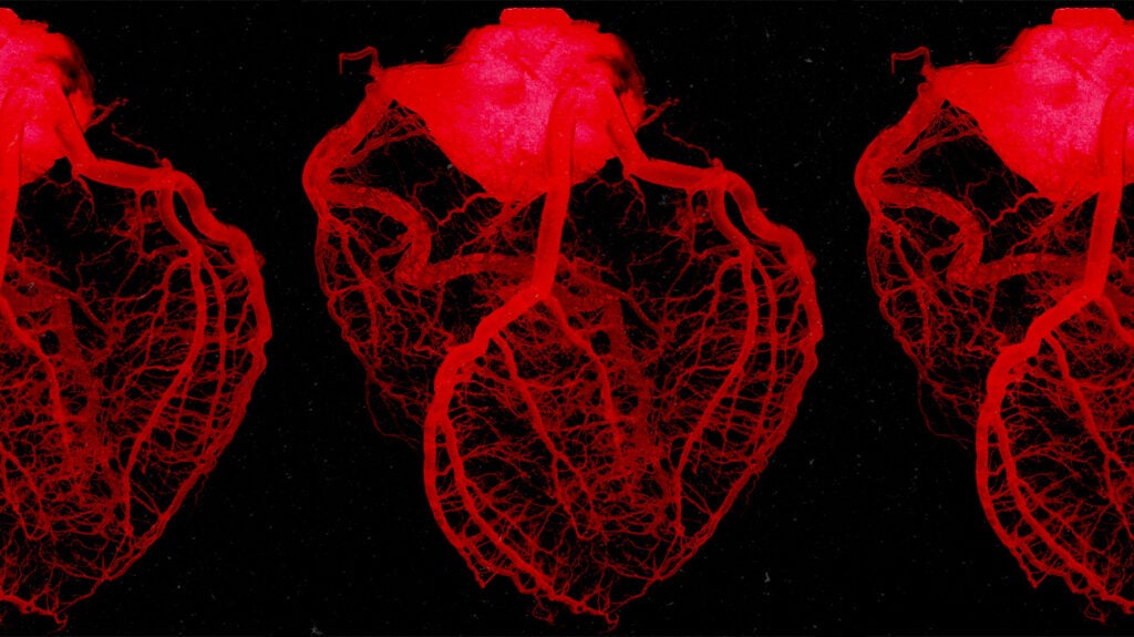 Mobitz Type II Heart Block Causes Symptoms And Treatment