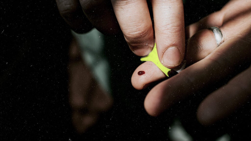 Diabetes and yeast infections (candidiasis): Risk, symptoms, and more