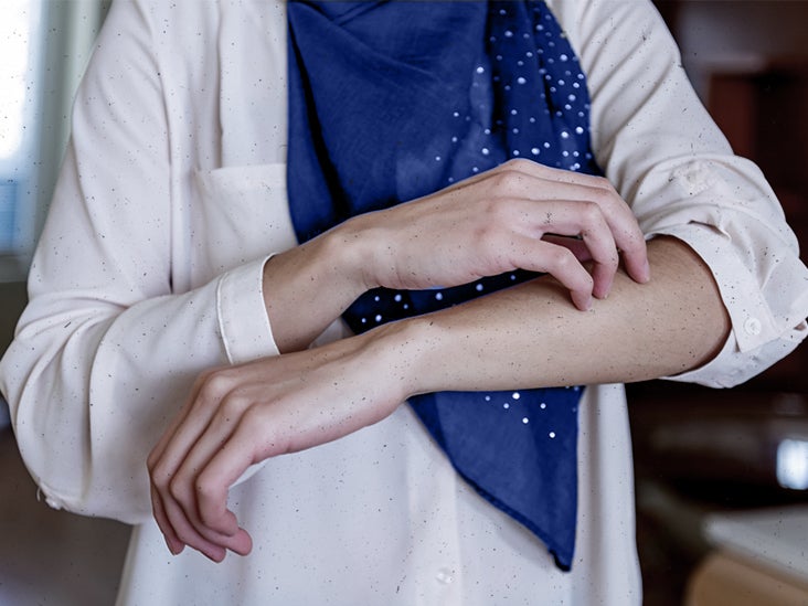 Acute eczema: Symptoms, causes, treatment, and more