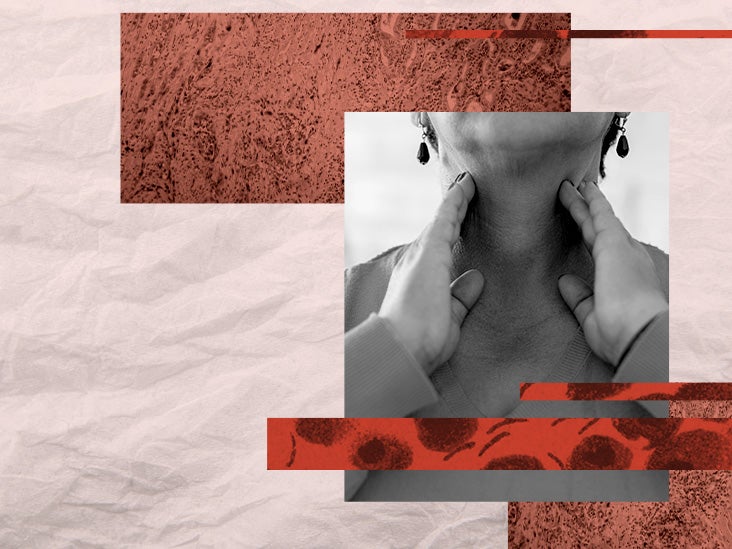 Anaplastic thyroid cancer: Symptoms, treatment, survival, and more