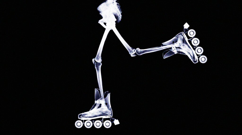 Avascular necrosis: Symptoms, treatment, and more