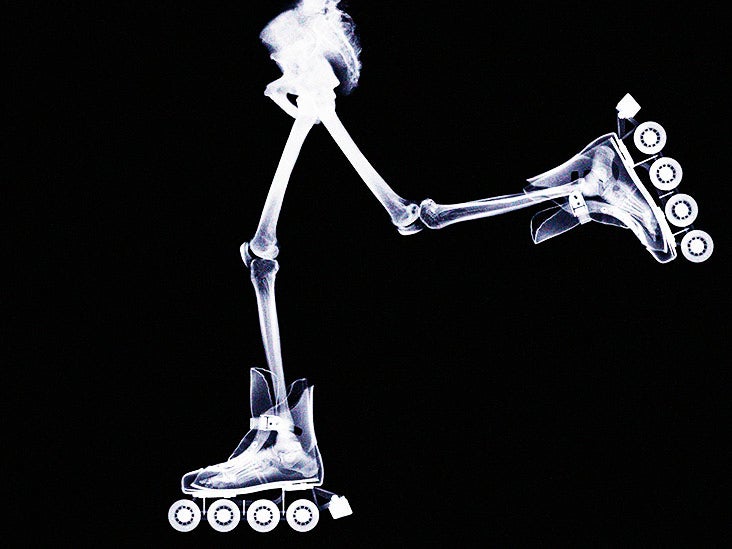 Avascular necrosis: Symptoms, treatment, and more