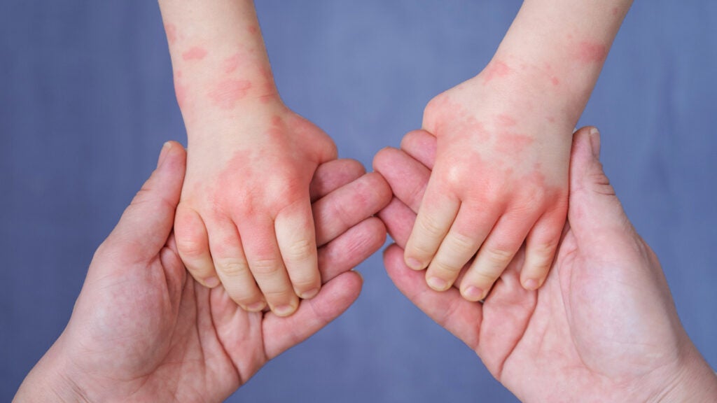 Papular Eczema: Symptoms, Causes, And Treatments, 54% OFF