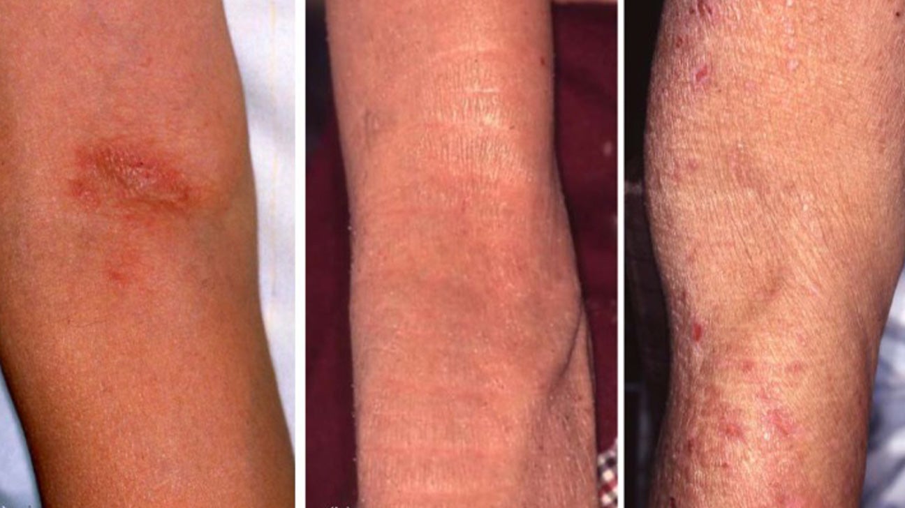Japanese Guidelines For Atopic Dermatitis 2017 54 Off