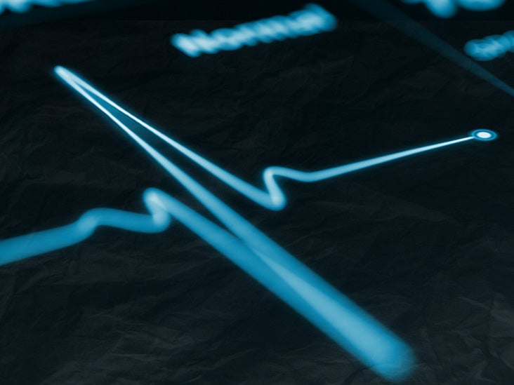 Left bundle branch block: Symptoms, causes, and treatment