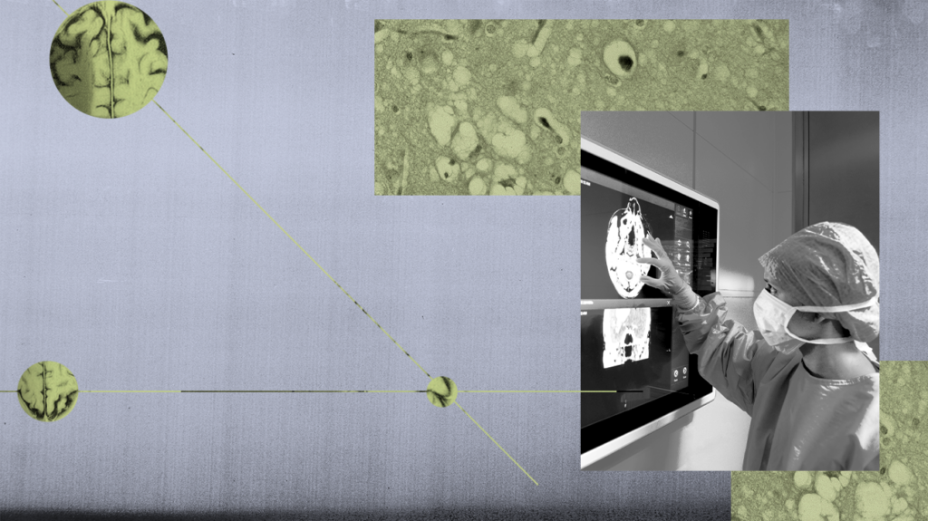 Prion disease: Definition, symptoms, treatment, and more