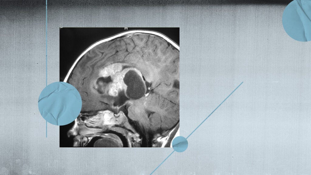 Rhabdoid tumor: Symptoms, causes, treatment, and outlook