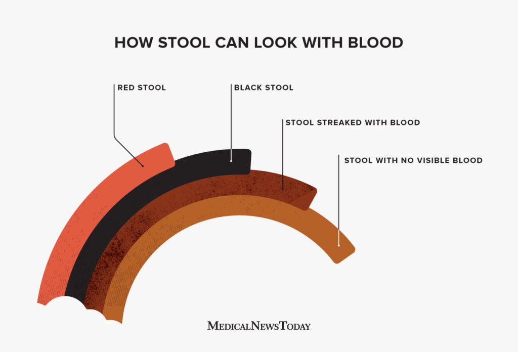 Blood In Stool Causes And When To Worry
