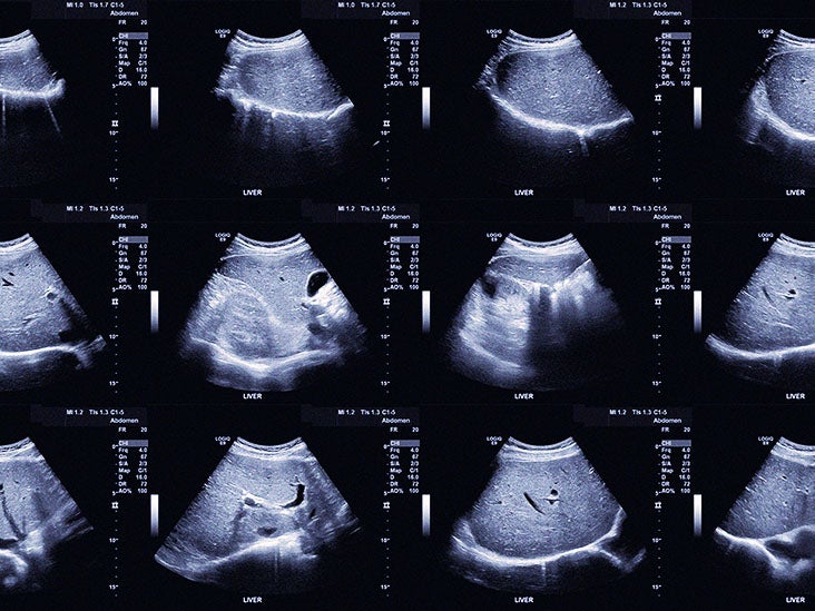 Budd-Chiari syndrome: Symptoms and treatments