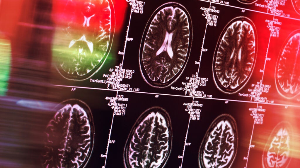 Wallenberg syndrome: Symptoms and treatment options