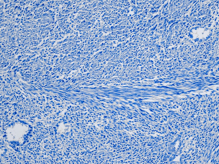 Synovial (soft tissue) sarcoma: What to know