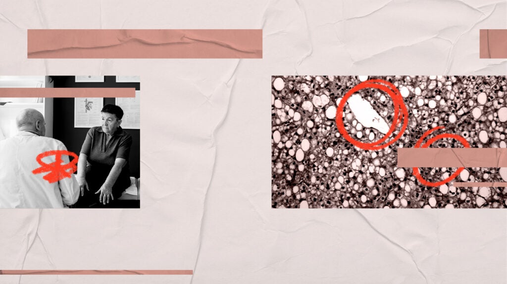 Steatosis: Definition, symptoms, treatment, and more