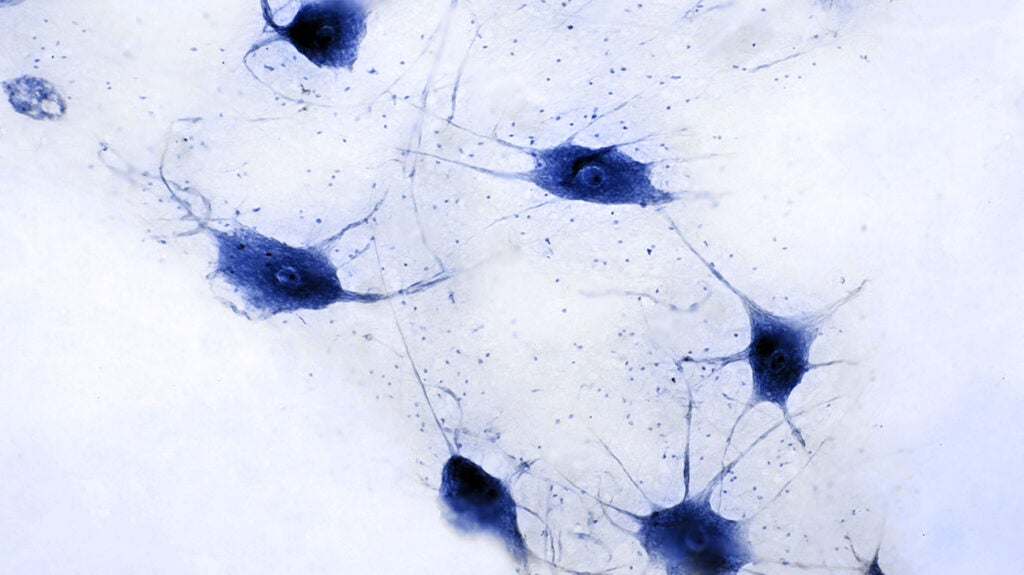 Demyelinating disease: What is it, types, causes