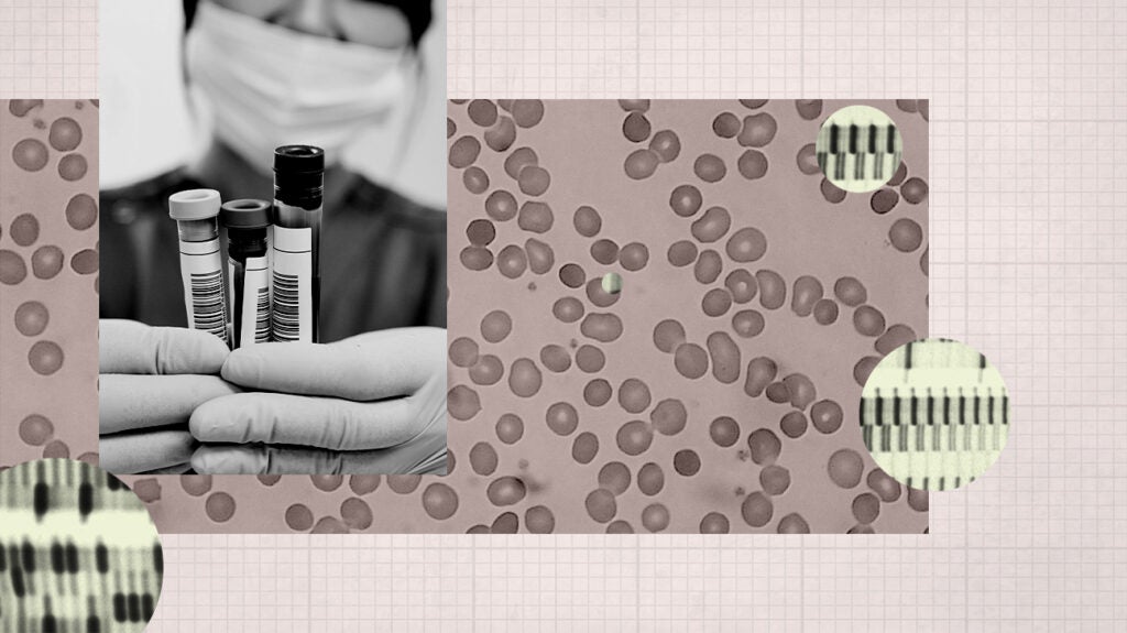 Hereditary spherocytosis: Symptoms, treatment, and more